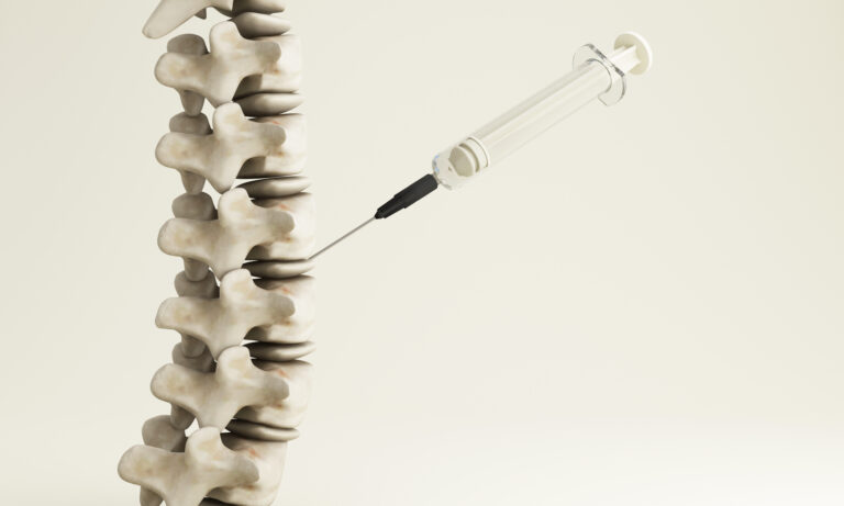 What To Do When Epidural Injections Dont Work Pmir